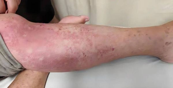 女性尿酸高的早期表现_尿酸高初期症状有哪些-第1张图片-山城妙识 女性尿酸高的早期表现_尿酸高初期症状有哪些-第1张图片-山城妙识