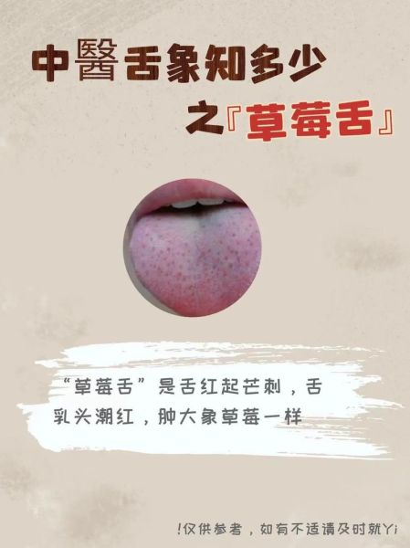 草莓舌头图片_草莓舌头是什么原因-第1张图片-山城妙识