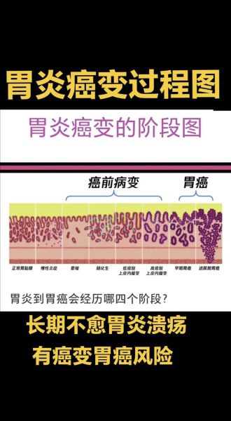 慢性胃炎多久会癌变_慢性胃炎癌变的几率有多大-第1张图片-山城妙识