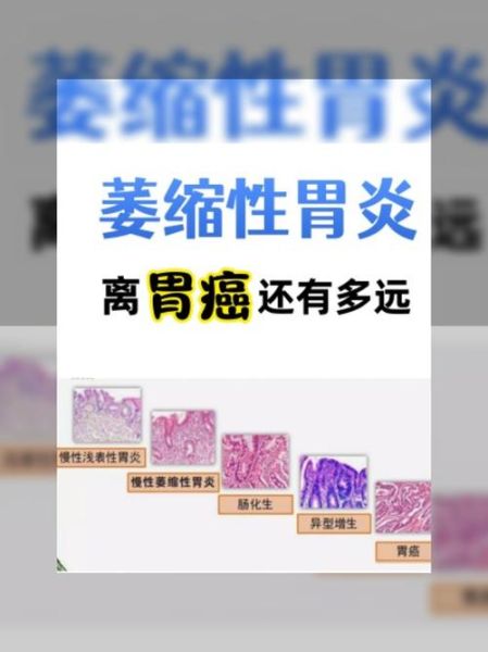 慢性胃炎多久会癌变_慢性胃炎癌变的几率有多大-第3张图片-山城妙识