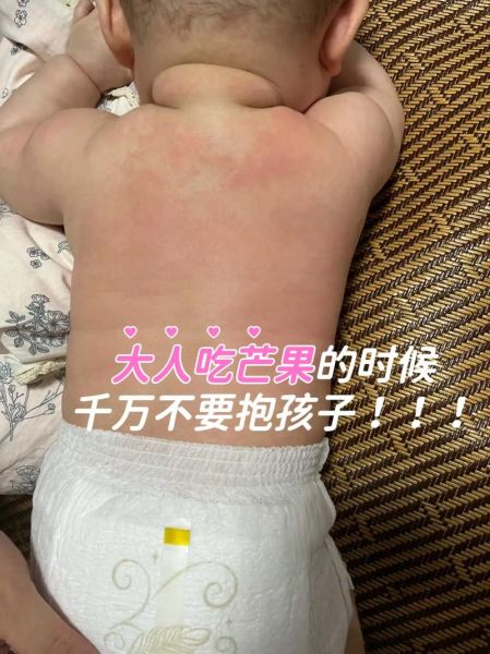 吃芒果过敏怎么办_芒果过敏症状多久消退-第1张图片-山城妙识