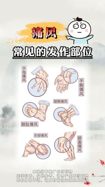 女人痛风先痛在哪里_女性痛风初期症状部位-第1张图片-山城妙识