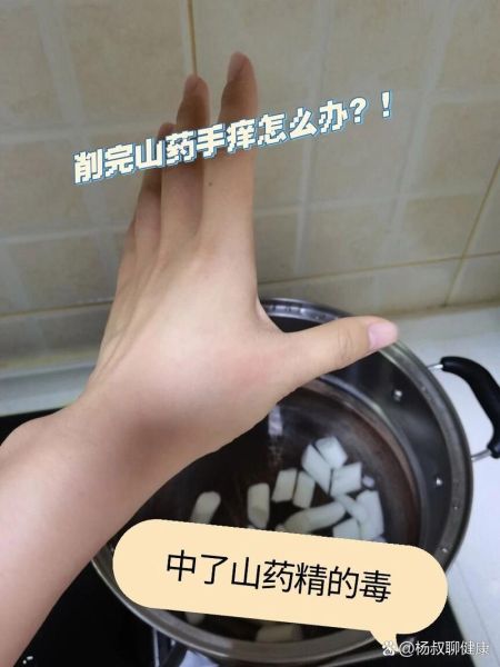 铁棍山药过敏痒怎么办_山药手痒快速止痒-第3张图片-山城妙识