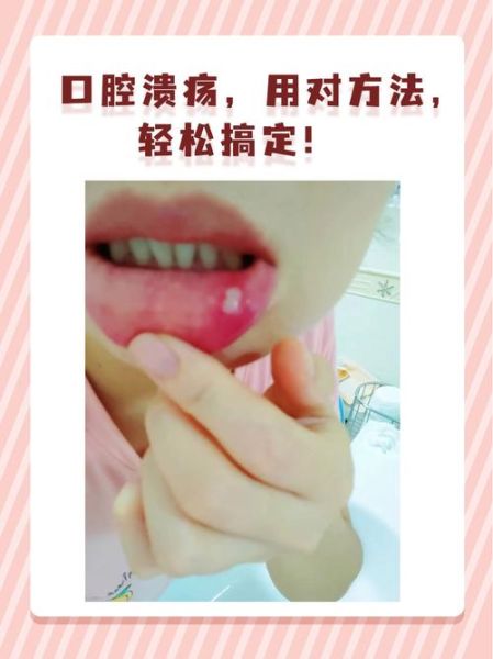 口腔溃疡怎么快速好_嘴巴里面溃疡小秘方-第3张图片-山城妙识