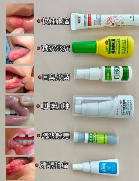 口腔溃疡怎么快速好_嘴巴里面溃疡小秘方-第2张图片-山城妙识