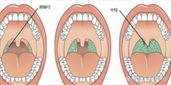 扁桃体肿大分度图解_一度二度三度怎么区分-第1张图片-山城妙识