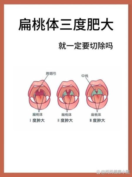 扁桃体肿大分度图解_一度二度三度怎么区分-第2张图片-山城妙识