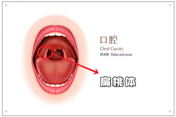 扁桃体肿大分度图解_一度二度三度怎么区分-第3张图片-山城妙识
