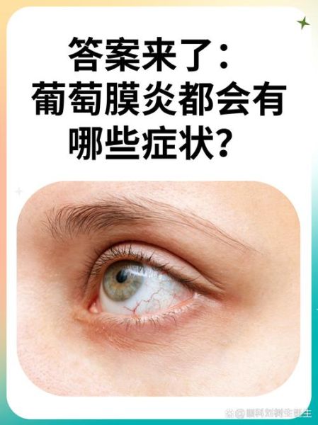 脉络膜是什么_脉络膜炎怎么治疗-第3张图片-山城妙识 脉络膜是什么_脉络膜炎怎么治疗-第3张图片-山城妙识