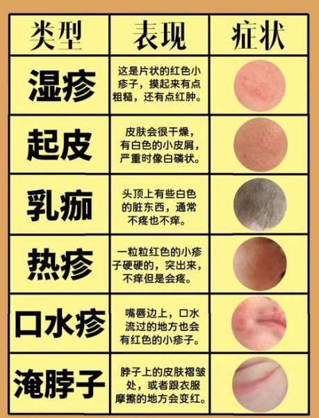 湿疹最怕的三个土办法_真的有用吗-第1张图片-山城妙识 湿疹最怕的三个土办法_真的有用吗-第1张图片-山城妙识