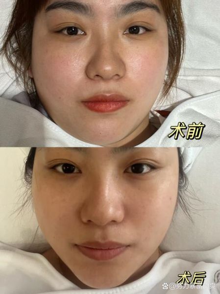 吃什么瘦脸最快最有效_脸部浮肿怎么消除-第2张图片-山城妙识