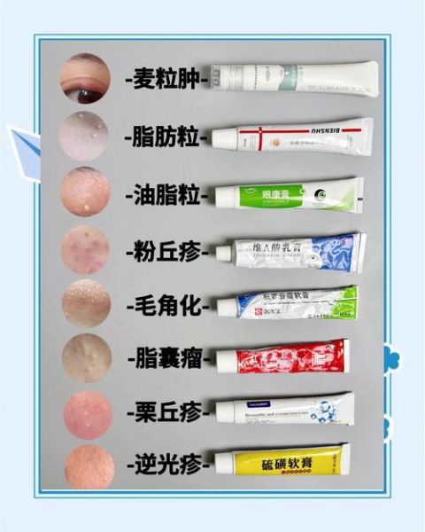 脂肪粒怎么去除_脂肪粒用什么药膏-第1张图片-山城妙识 脂肪粒怎么去除_脂肪粒用什么药膏-第1张图片-山城妙识