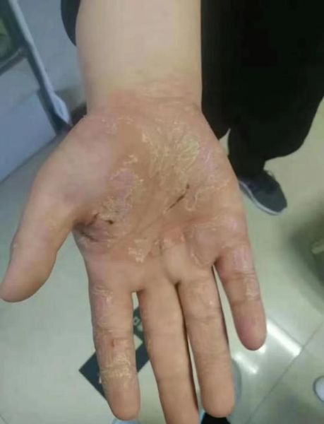 鹅掌风手干裂怎么治疗_手癣干裂最快恢复方法-第1张图片-山城妙识