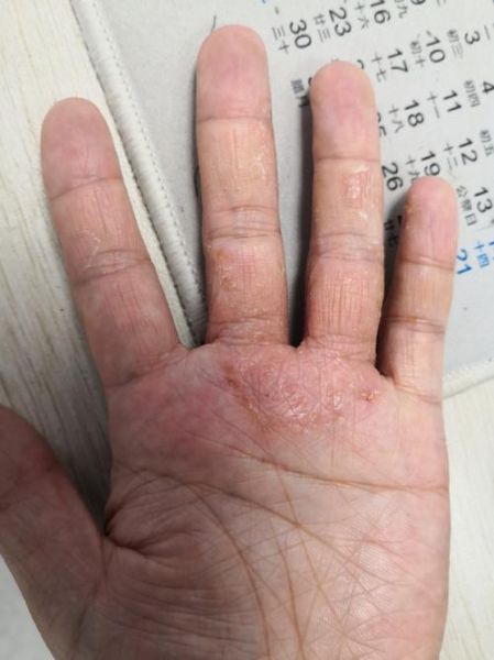 鹅掌风手干裂怎么治疗_手癣干裂最快恢复方法-第3张图片-山城妙识