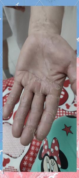 鹅掌风手干裂怎么治疗_手癣干裂最快恢复方法-第2张图片-山城妙识