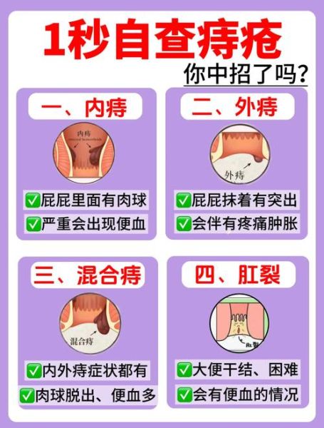 痔疮可以自愈吗_痔疮不治疗会好吗-第3张图片-山城妙识