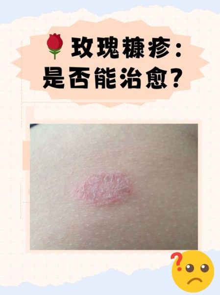 玫瑰糠疹传染吗_玫瑰糠疹会传染给家人吗-第1张图片-山城妙识
