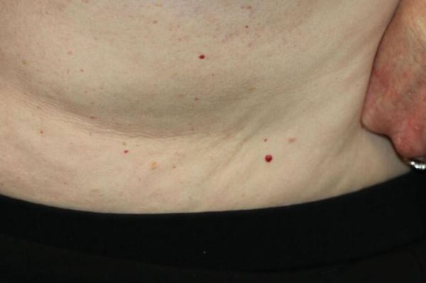 樱桃是身体什么部位_樱桃状血管瘤是什么-第1张图片-山城妙识