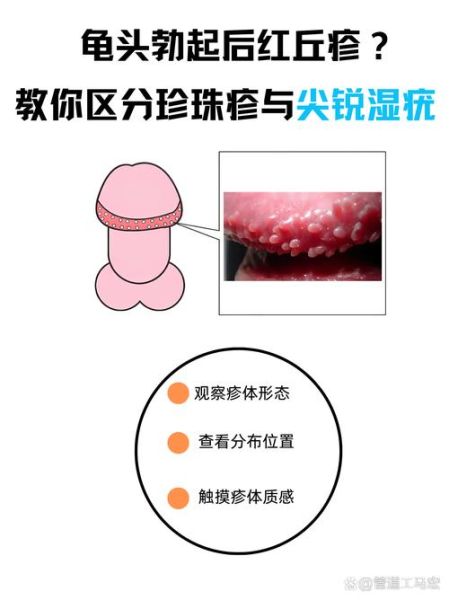 珍珠疹的症状有哪些_珍珠疹和尖锐湿疣区别-第1张图片-山城妙识