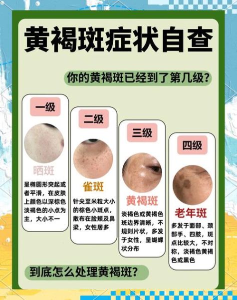 什么东西可以祛斑最快_祛斑效果最好的方法是什么-第1张图片-山城妙识 什么东西可以祛斑最快_祛斑效果最好的方法是什么-第1张图片-山城妙识