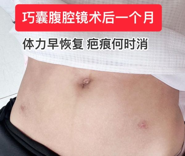 巧克力囊肿手术过程_术后多久恢复-第2张图片-山城妙识