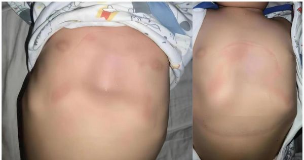 女性鸡胸怎么矫正_鸡胸手术多少钱-第1张图片-山城妙识