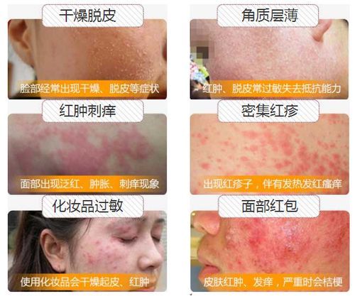 过敏症状图片怎么看_如何快速识别-第3张图片-山城妙识