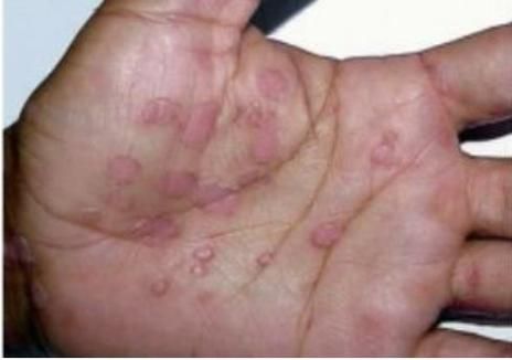 男性菜花病初期症状图片_菜花病长什么样-第1张图片-山城妙识