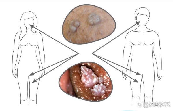 男性菜花病初期症状图片_菜花病长什么样-第3张图片-山城妙识