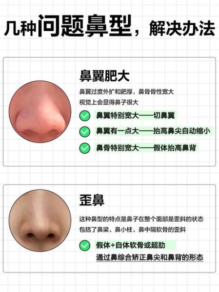 蒜头鼻长什么样_蒜头鼻怎么改善-第2张图片-山城妙识 蒜头鼻长什么样_蒜头鼻怎么改善-第2张图片-山城妙识