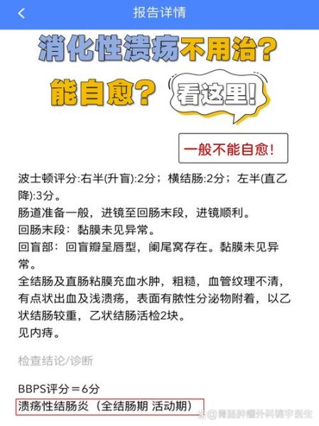 胃溃疡不吃药能自愈吗_胃溃疡多久能好-第1张图片-山城妙识