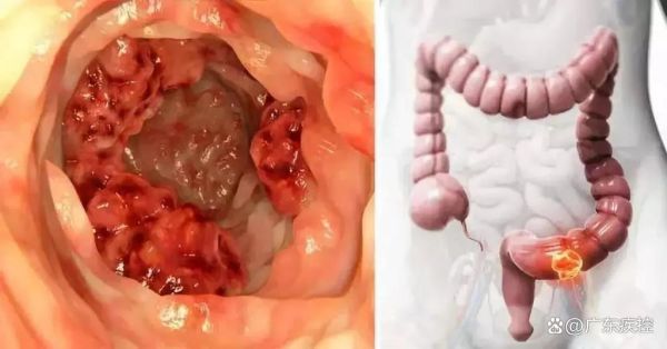 肠癌大便图片_肠癌早期大便特征-第3张图片-山城妙识 肠癌大便图片_肠癌早期大便特征-第3张图片-山城妙识