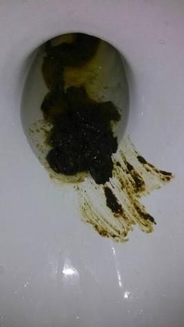 肠癌大便图片_肠癌早期大便特征-第1张图片-山城妙识 肠癌大便图片_肠癌早期大便特征-第1张图片-山城妙识