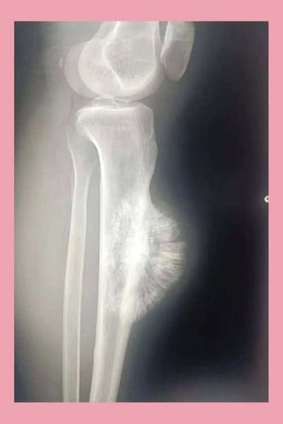 骨肉瘤早期症状有哪些_骨肉瘤疼痛特点是什么-第3张图片-山城妙识
