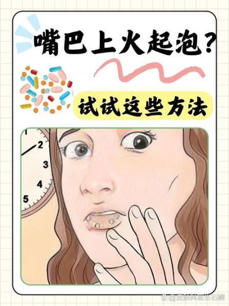 嘴巴上火起泡怎么快速消除_嘴角起泡几天能好-第1张图片-山城妙识