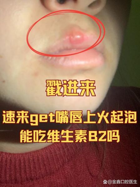 嘴巴上火起泡怎么快速消除_嘴角起泡几天能好-第2张图片-山城妙识