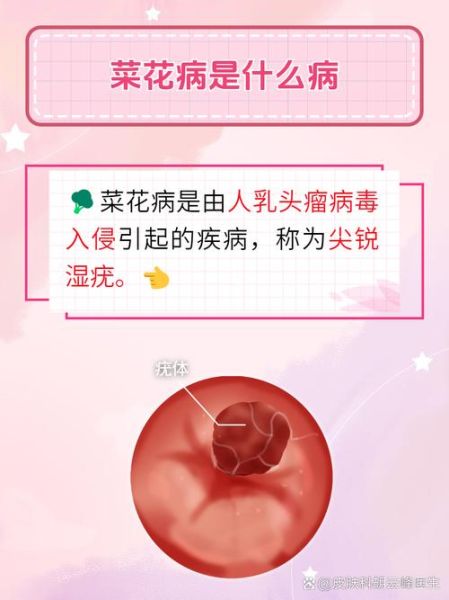 菜花样病变是什么_怎么治疗-第1张图片-山城妙识