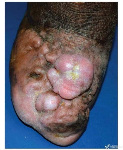 菜花样病变是什么_怎么治疗-第3张图片-山城妙识