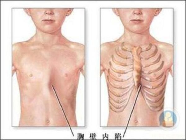 佝偻病早期症状图片_佝偻病能治好吗-第1张图片-山城妙识 佝偻病早期症状图片_佝偻病能治好吗-第1张图片-山城妙识