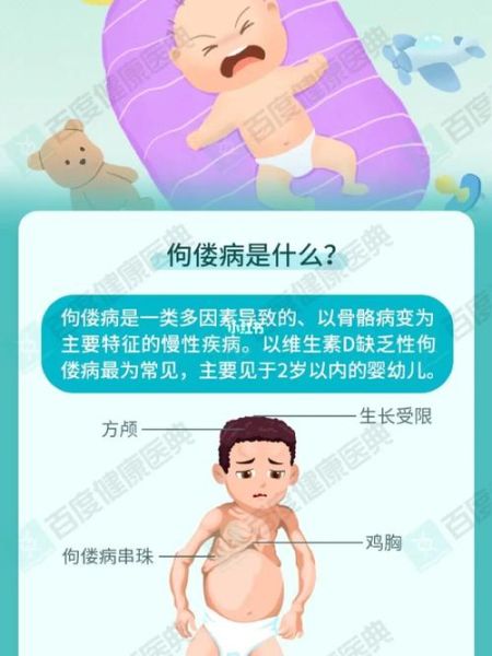佝偻病早期症状图片_佝偻病能治好吗-第2张图片-山城妙识 佝偻病早期症状图片_佝偻病能治好吗-第2张图片-山城妙识
