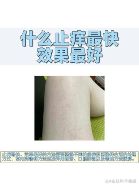 皮肤止痒的最快的方法_皮肤痒怎么快速止痒-第2张图片-山城妙识