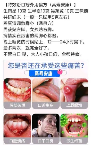 治口疮民间最好偏方_口腔溃疡怎么快速好-第1张图片-山城妙识 治口疮民间最好偏方_口腔溃疡怎么快速好-第1张图片-山城妙识
