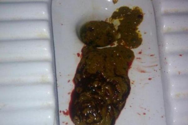 早期肠癌大便图片_肠癌大便颜色形状变化-第1张图片-山城妙识