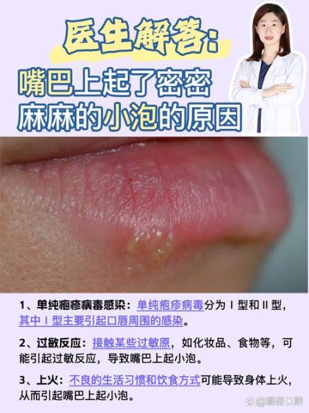 嘴角边有一团小粒水泡_是什么原因-第1张图片-山城妙识 嘴角边有一团小粒水泡_是什么原因-第1张图片-山城妙识