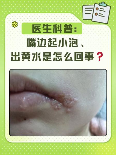 嘴角边有一团小粒水泡_是什么原因-第2张图片-山城妙识 嘴角边有一团小粒水泡_是什么原因-第2张图片-山城妙识