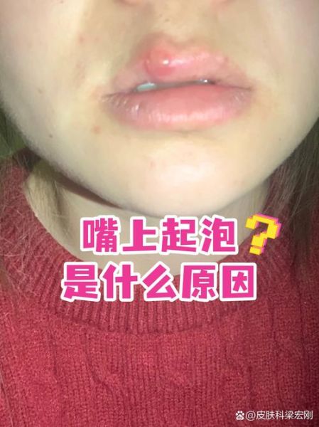 嘴角边有一团小粒水泡_是什么原因-第3张图片-山城妙识 嘴角边有一团小粒水泡_是什么原因-第3张图片-山城妙识