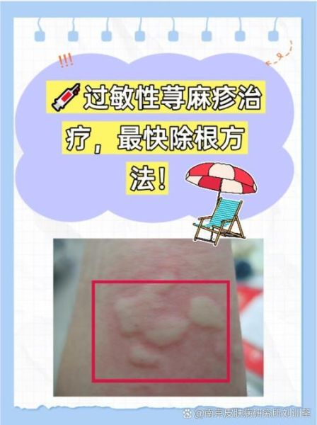 大蒜治荨麻疹真的有用吗_怎么用大蒜快速止痒-第1张图片-山城妙识