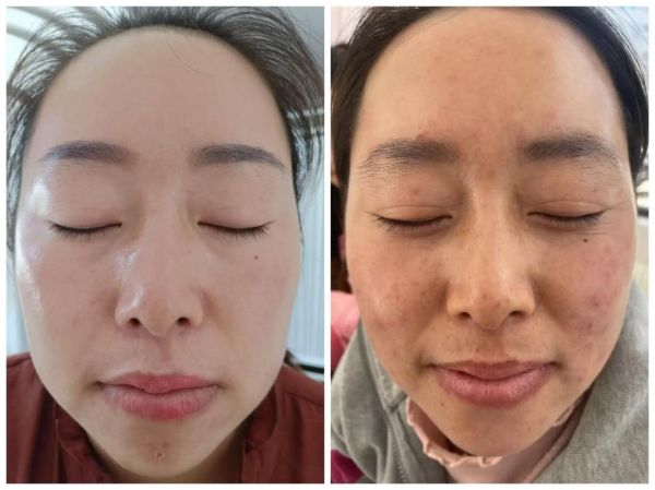 吃苹果后皮肤会变好吗_真实对比照揭秘-第2张图片-山城妙识