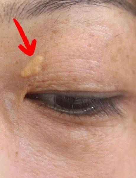 女性血脂高的早期症状_血脂高早期有哪些表现-第1张图片-山城妙识