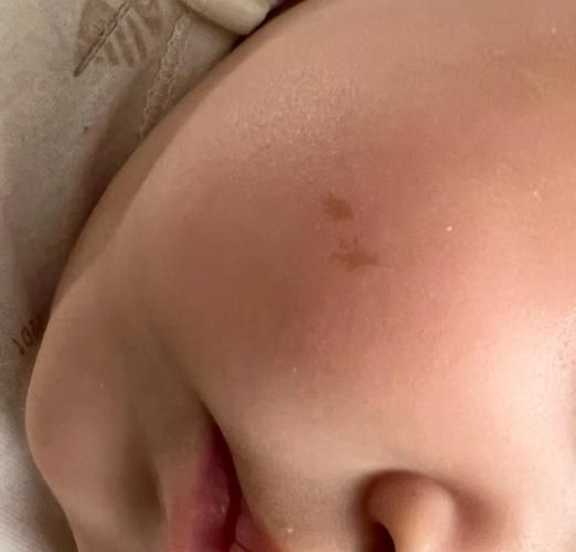 牛奶咖啡斑怎么治疗_会自己消失吗-第1张图片-山城妙识 牛奶咖啡斑怎么治疗_会自己消失吗-第1张图片-山城妙识